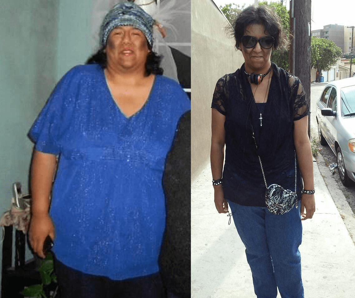 Gastric Bypass Before And After Black Women